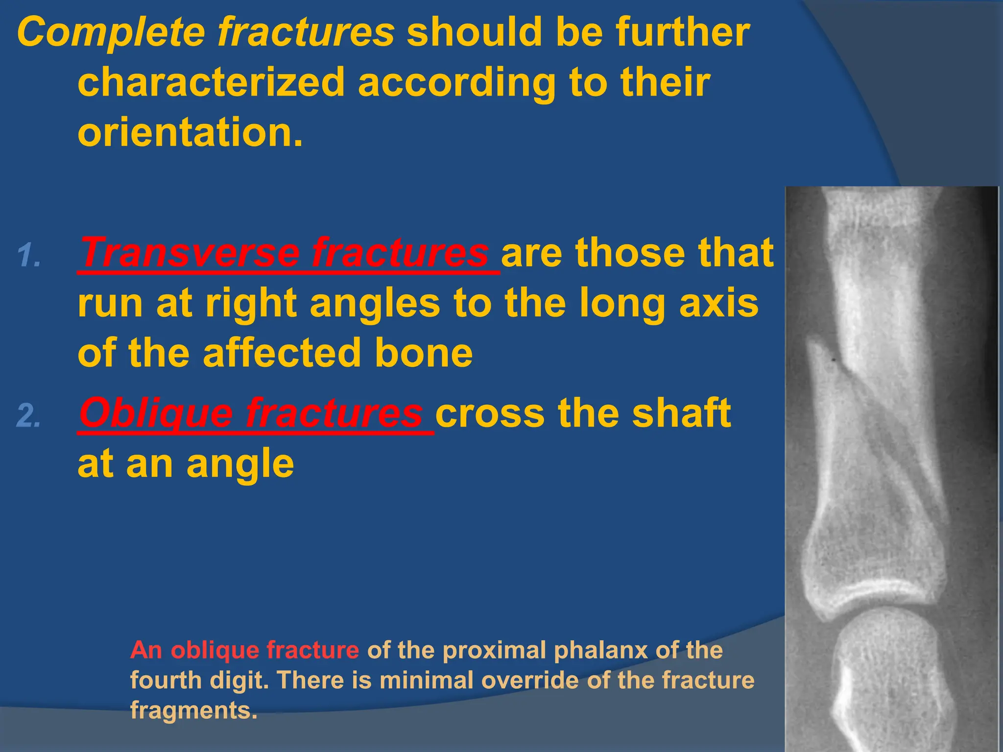 bone trauma common fractures long bone.ppt