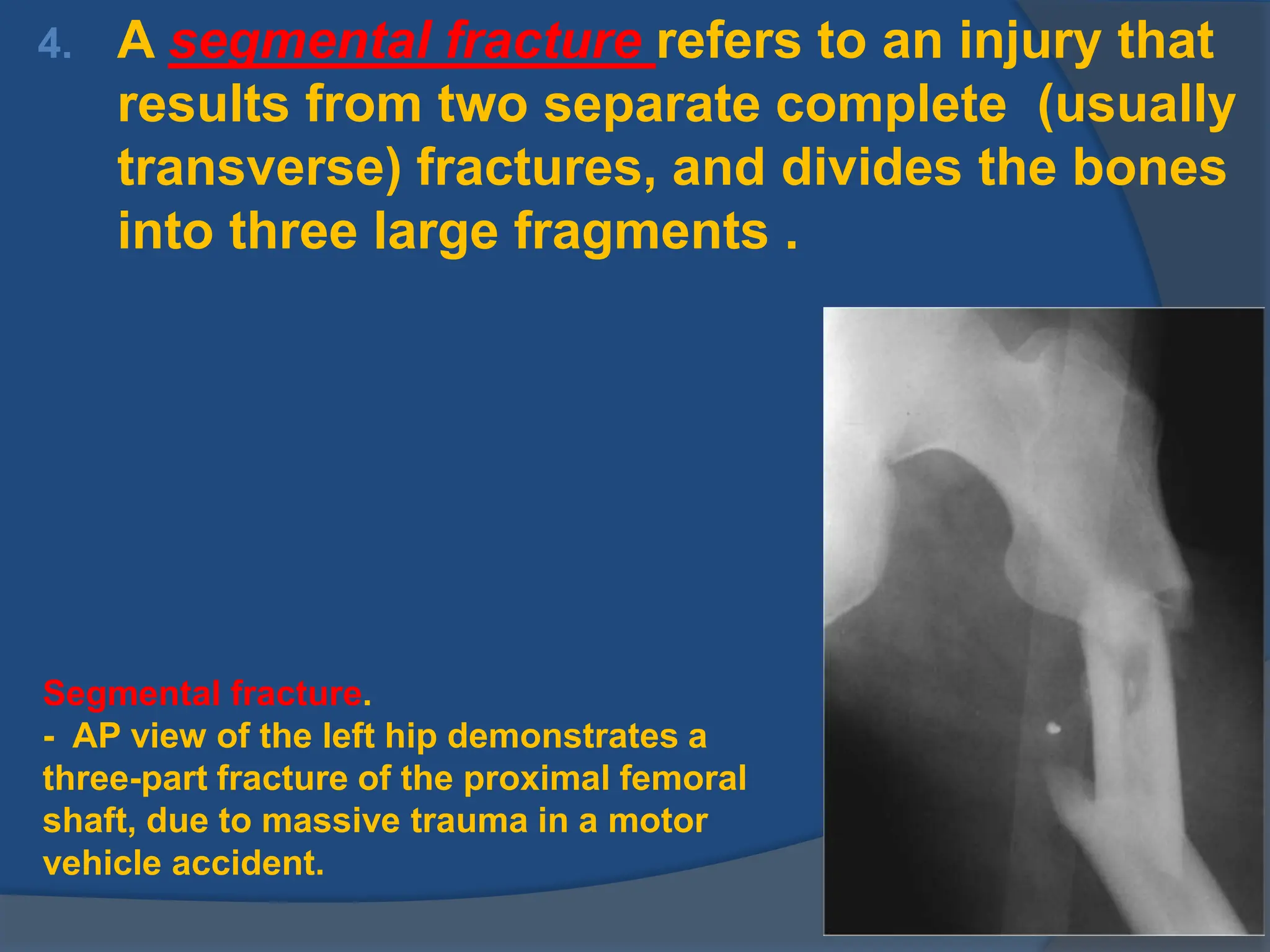 bone trauma common fractures long bone.ppt