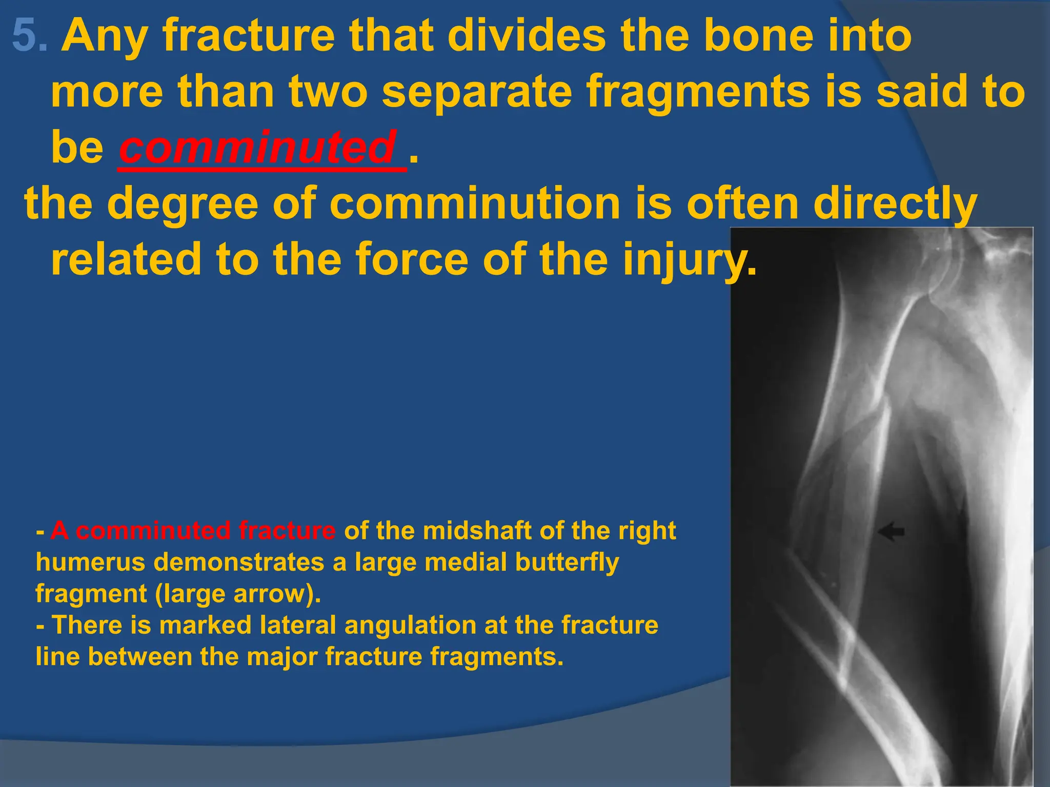 bone trauma common fractures long bone.ppt