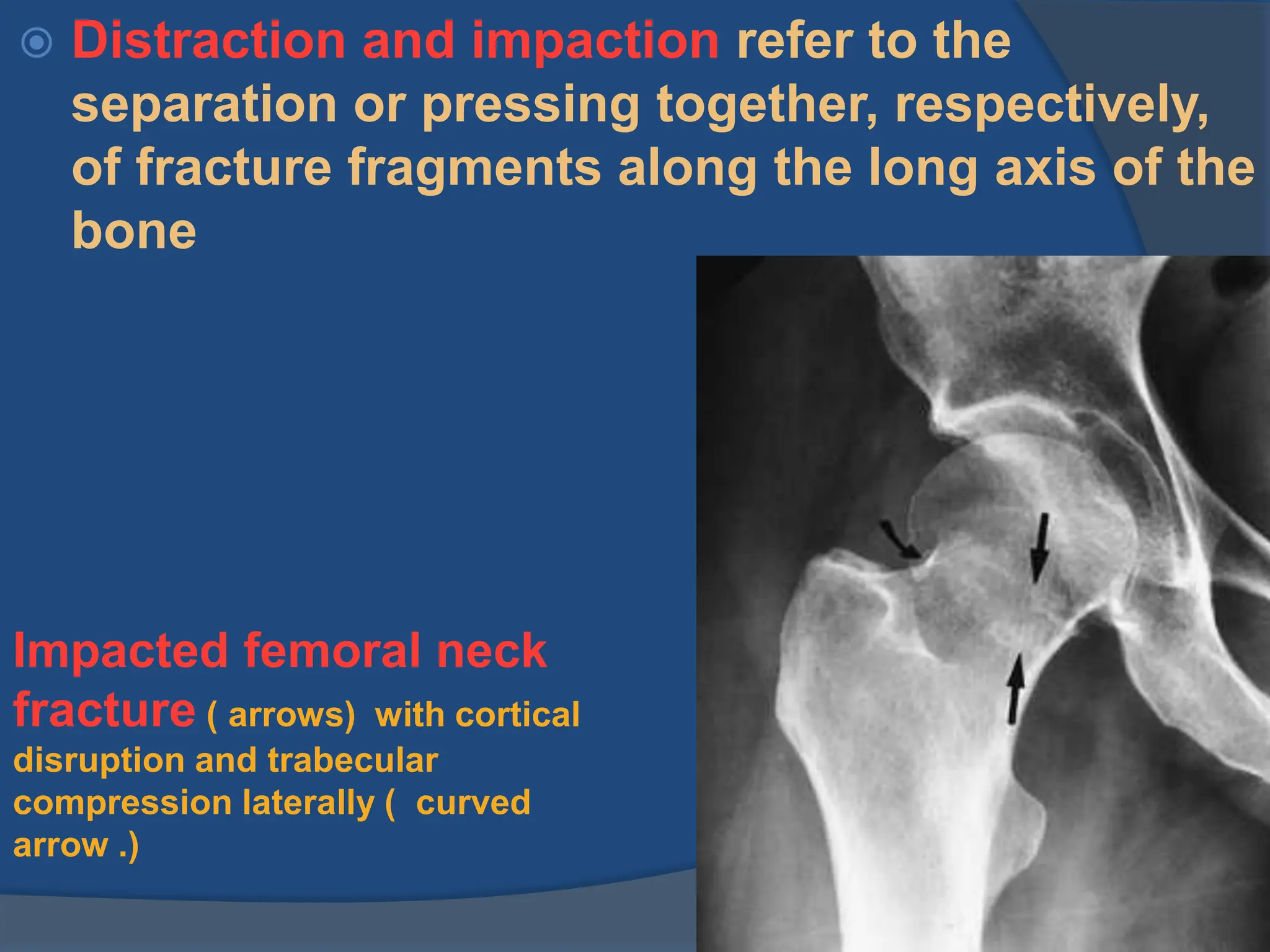 bone trauma common fractures long bone.ppt