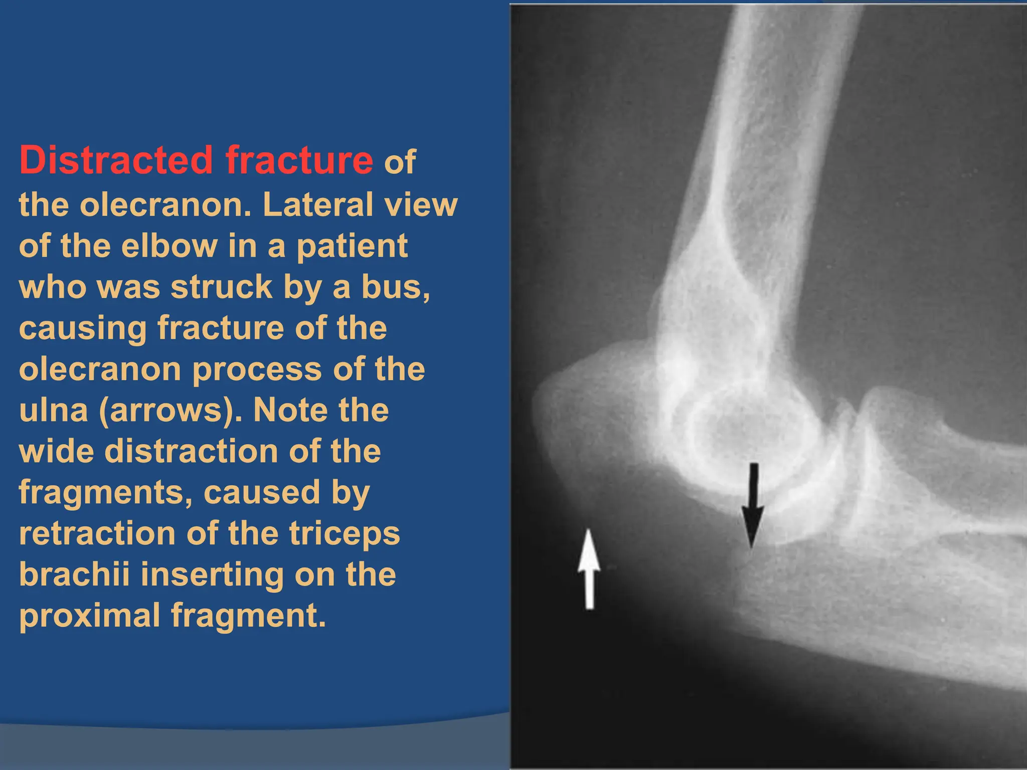 bone trauma common fractures long bone.ppt
