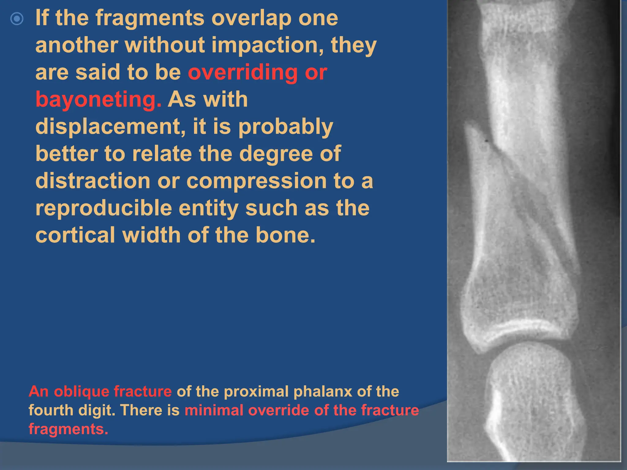 bone trauma common fractures long bone.ppt