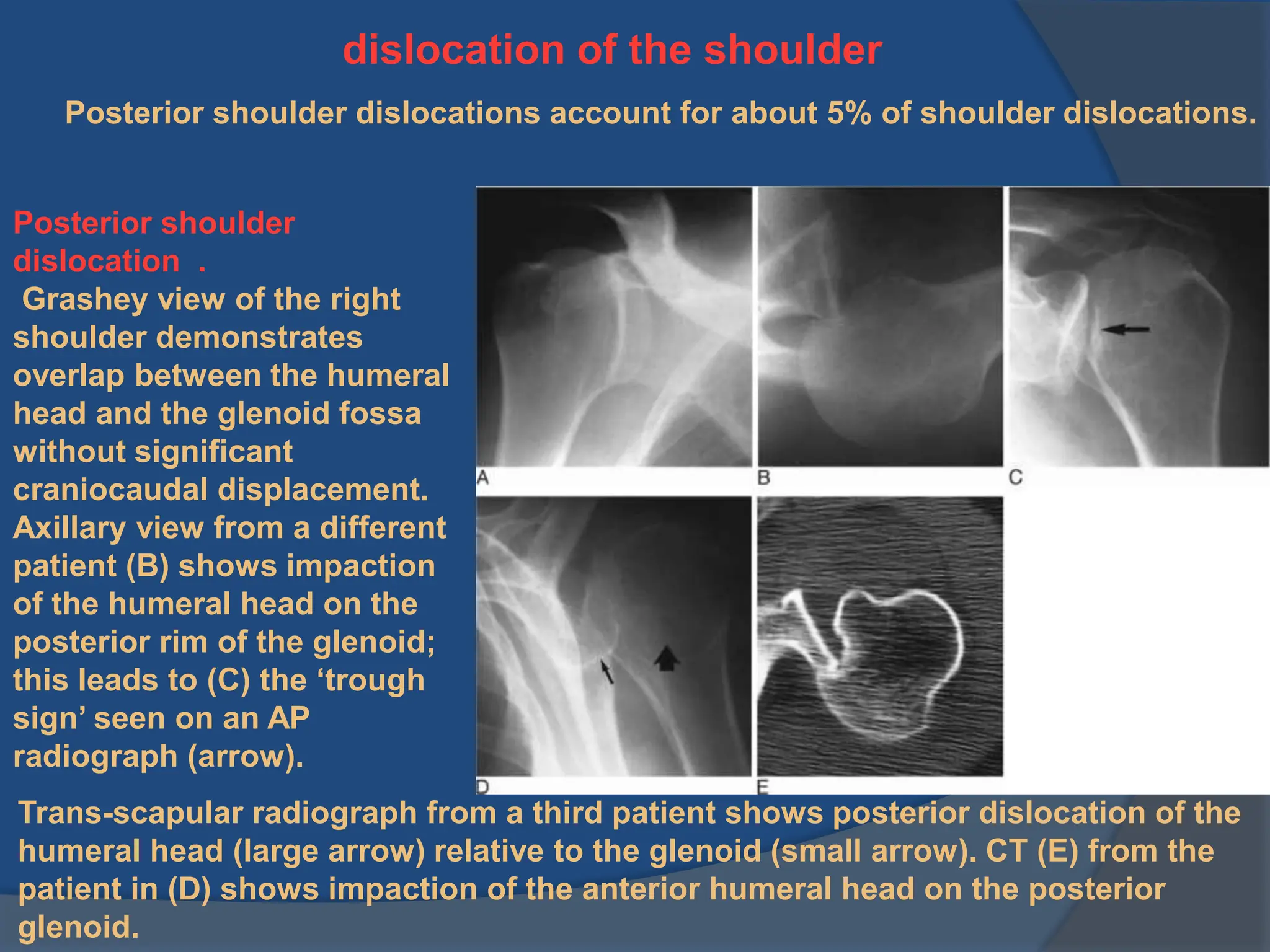 bone trauma common fractures long bone.ppt