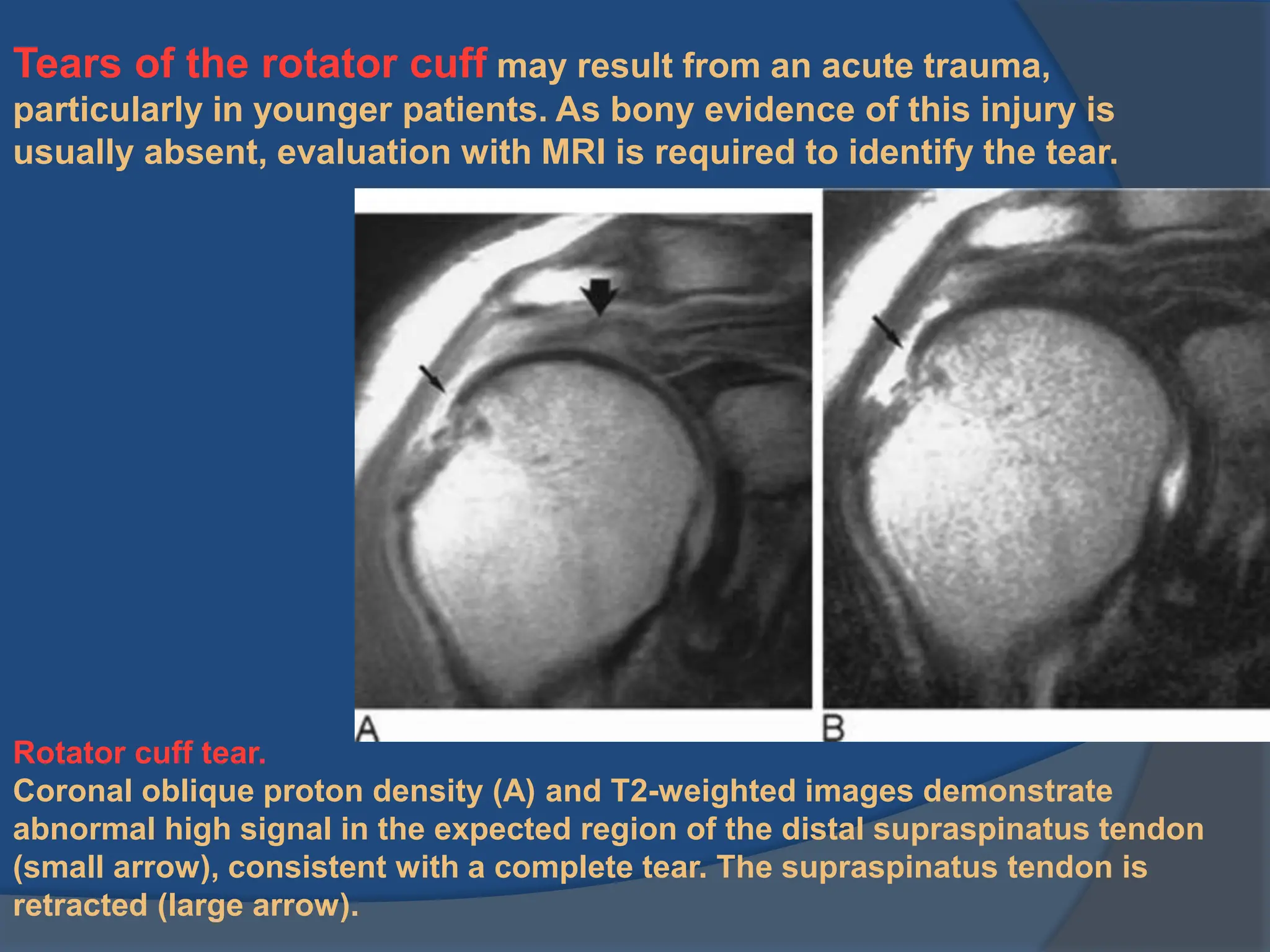 bone trauma common fractures long bone.ppt