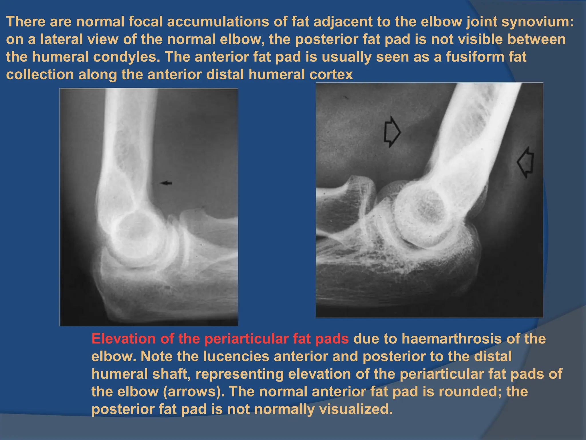 bone trauma common fractures long bone.ppt
