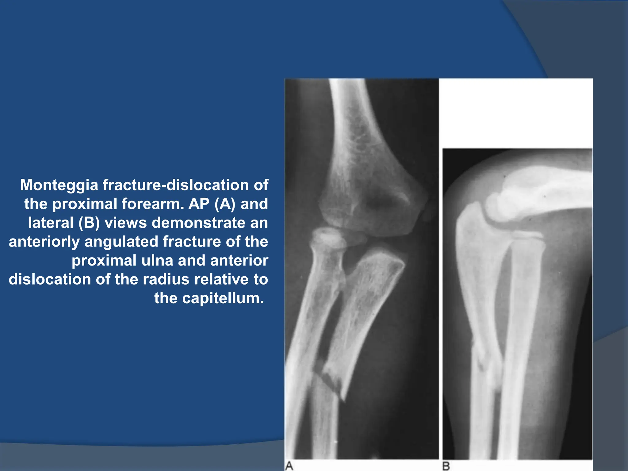 bone trauma common fractures long bone.ppt