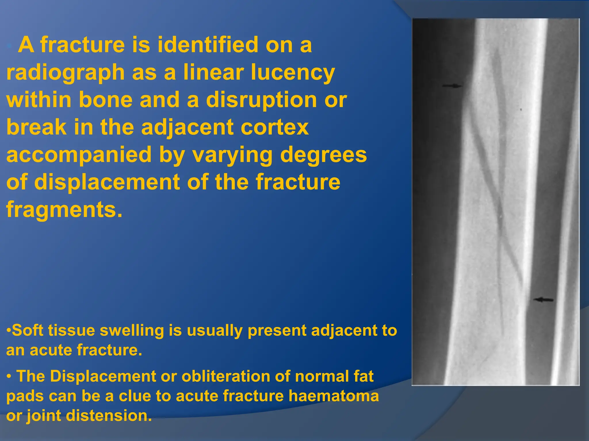 bone trauma common fractures long bone.ppt