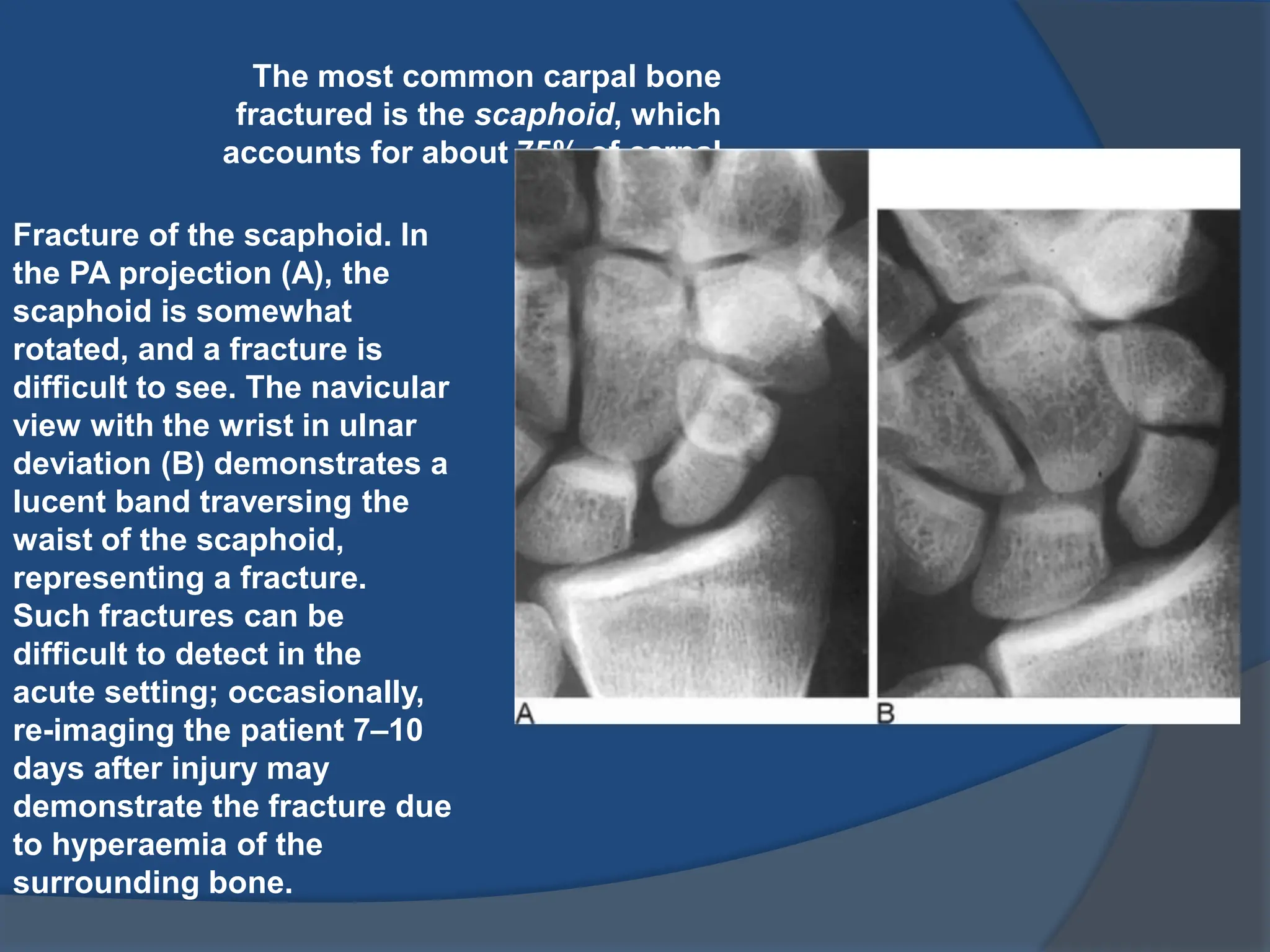 bone trauma common fractures long bone.ppt