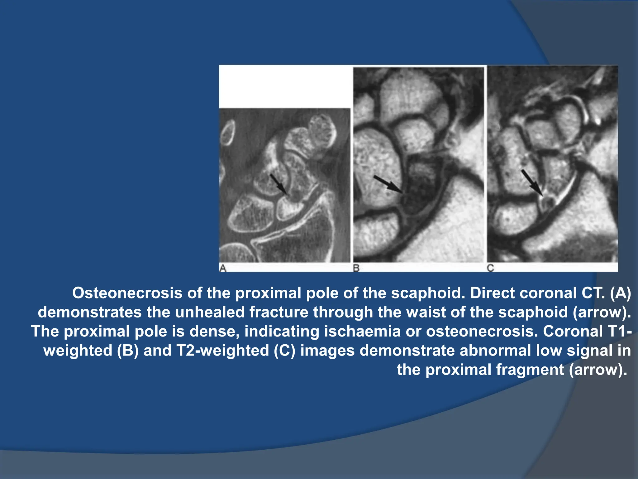 bone trauma common fractures long bone.ppt