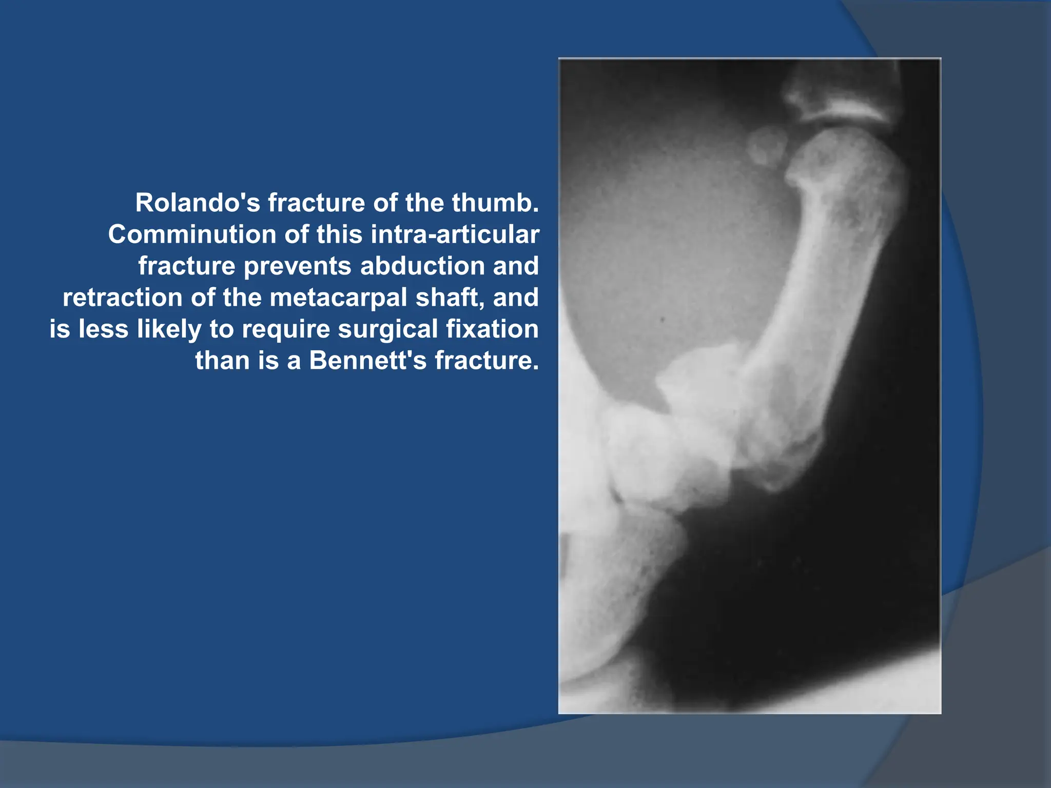 bone trauma common fractures long bone.ppt