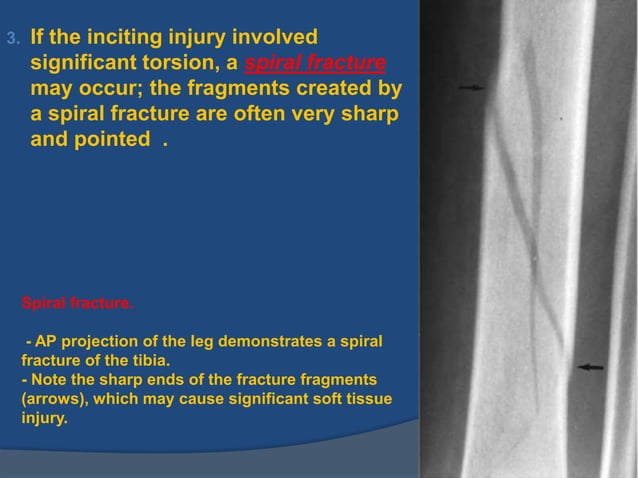 bone trauma common fractures long bone.ppt