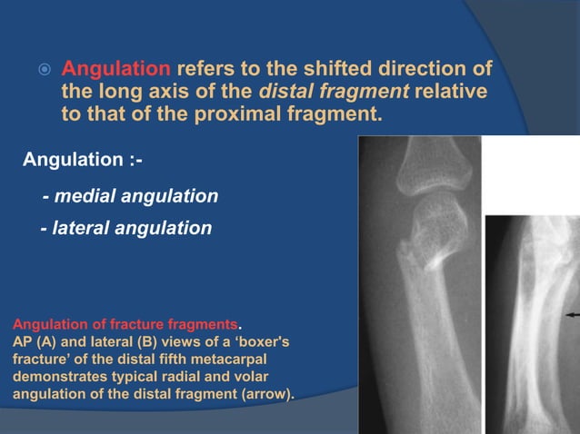 bone trauma common fractures long bone.ppt