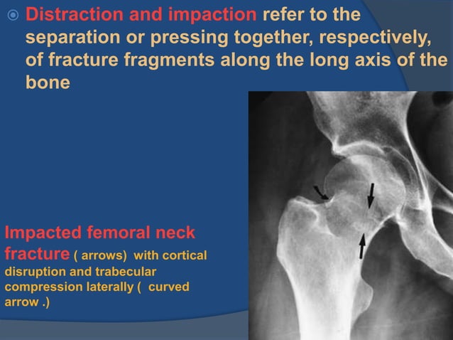 bone trauma common fractures long bone.ppt