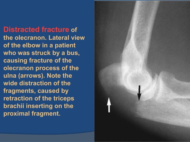bone trauma common fractures long bone.ppt