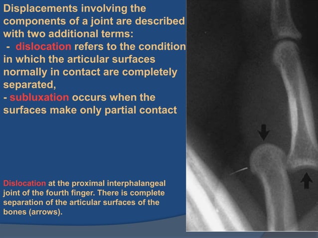 bone trauma common fractures long bone.ppt