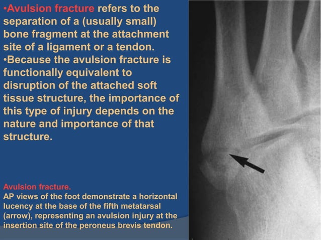 bone trauma common fractures long bone.ppt