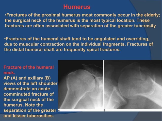 bone trauma common fractures long bone.ppt