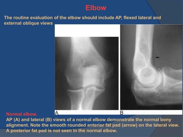 bone trauma common fractures long bone.ppt