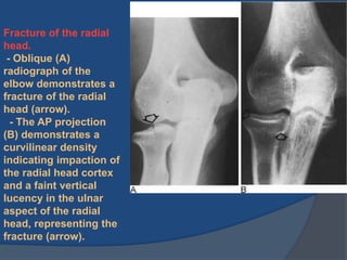 bone trauma common fractures long bone.ppt