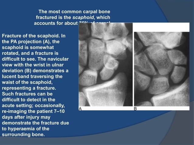 bone trauma common fractures long bone.ppt
