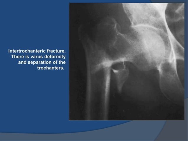 bone trauma common fractures long bone.ppt