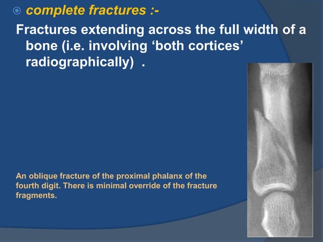 bone trauma common fractures long bone.ppt