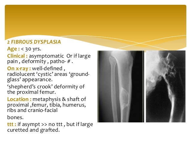 Bone tumor
