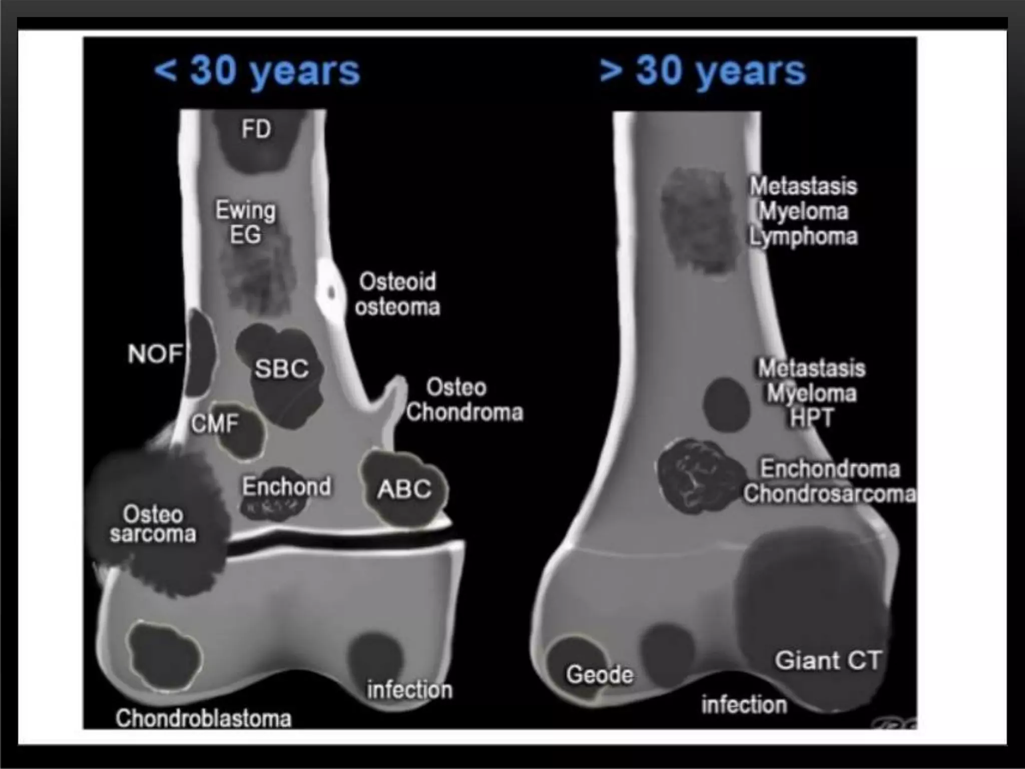 BENIGN Bone tumors | PPT