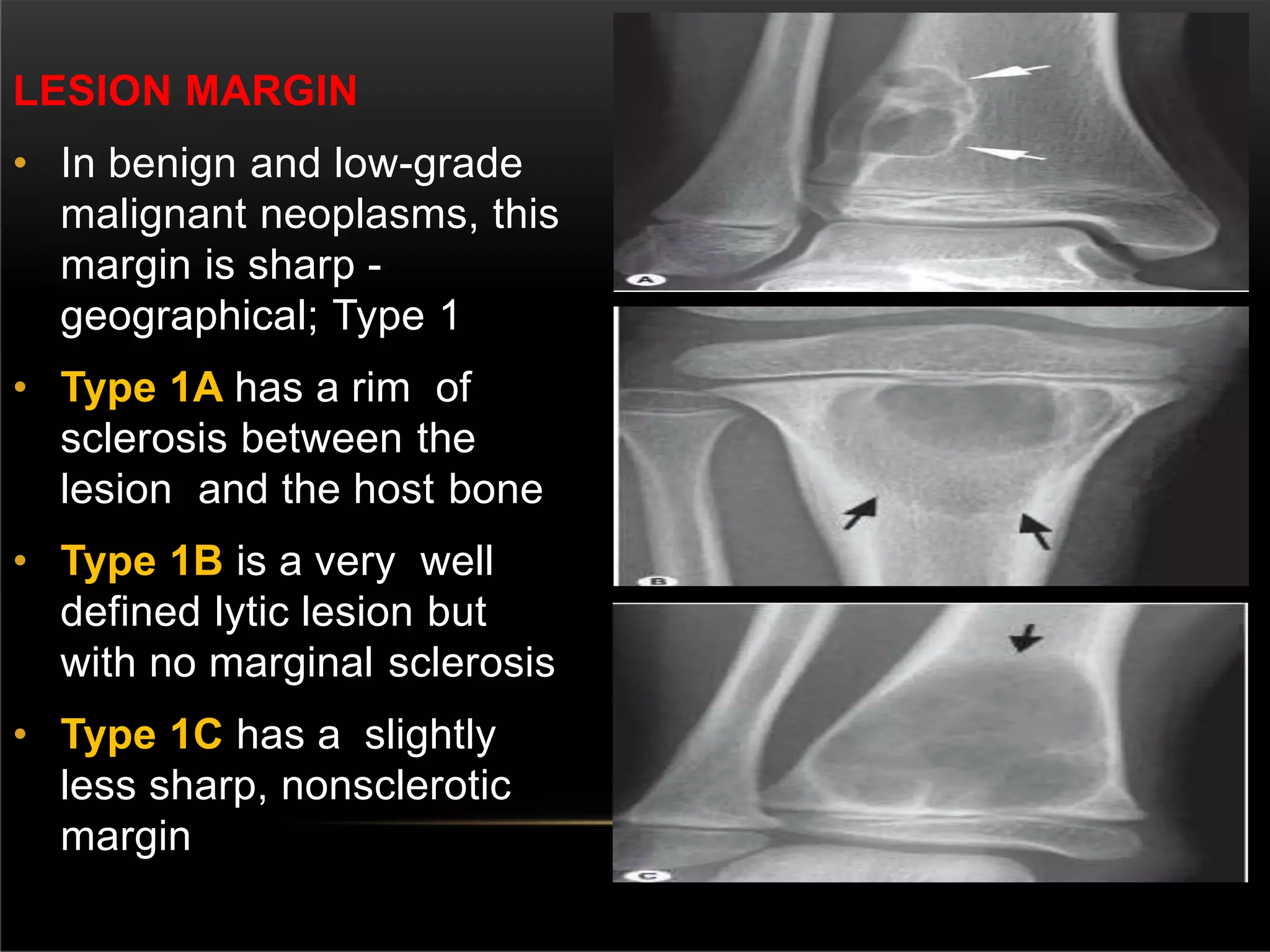 BENIGN Bone tumors | PPT