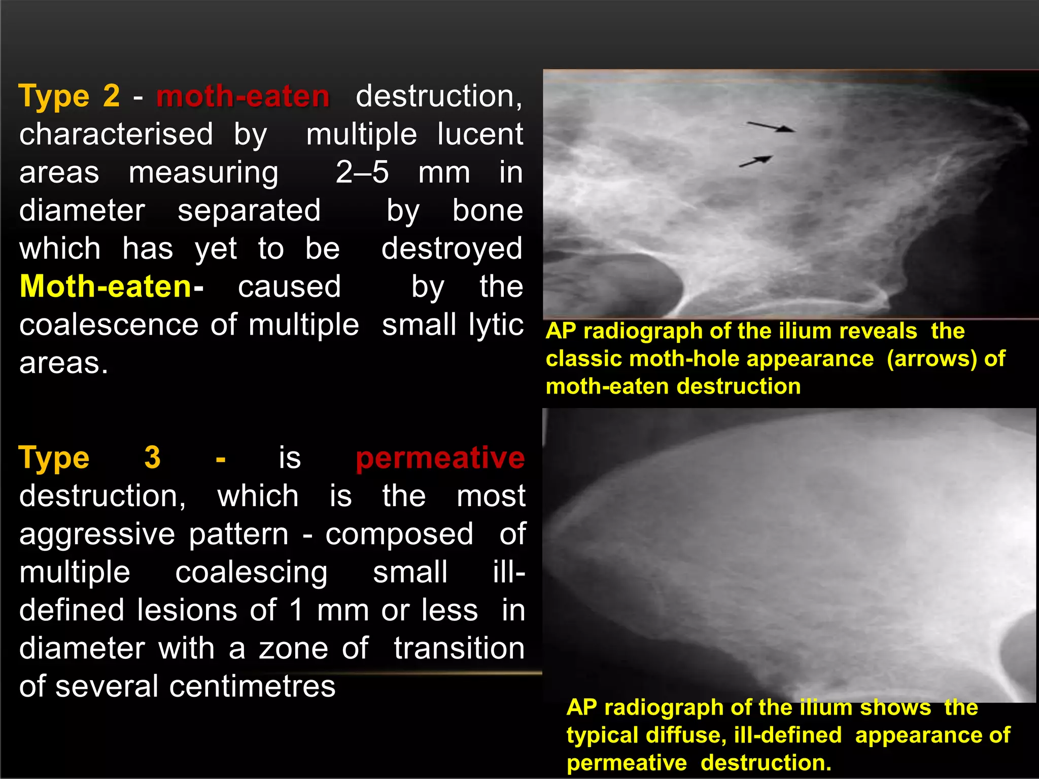 BENIGN Bone tumors | PPT