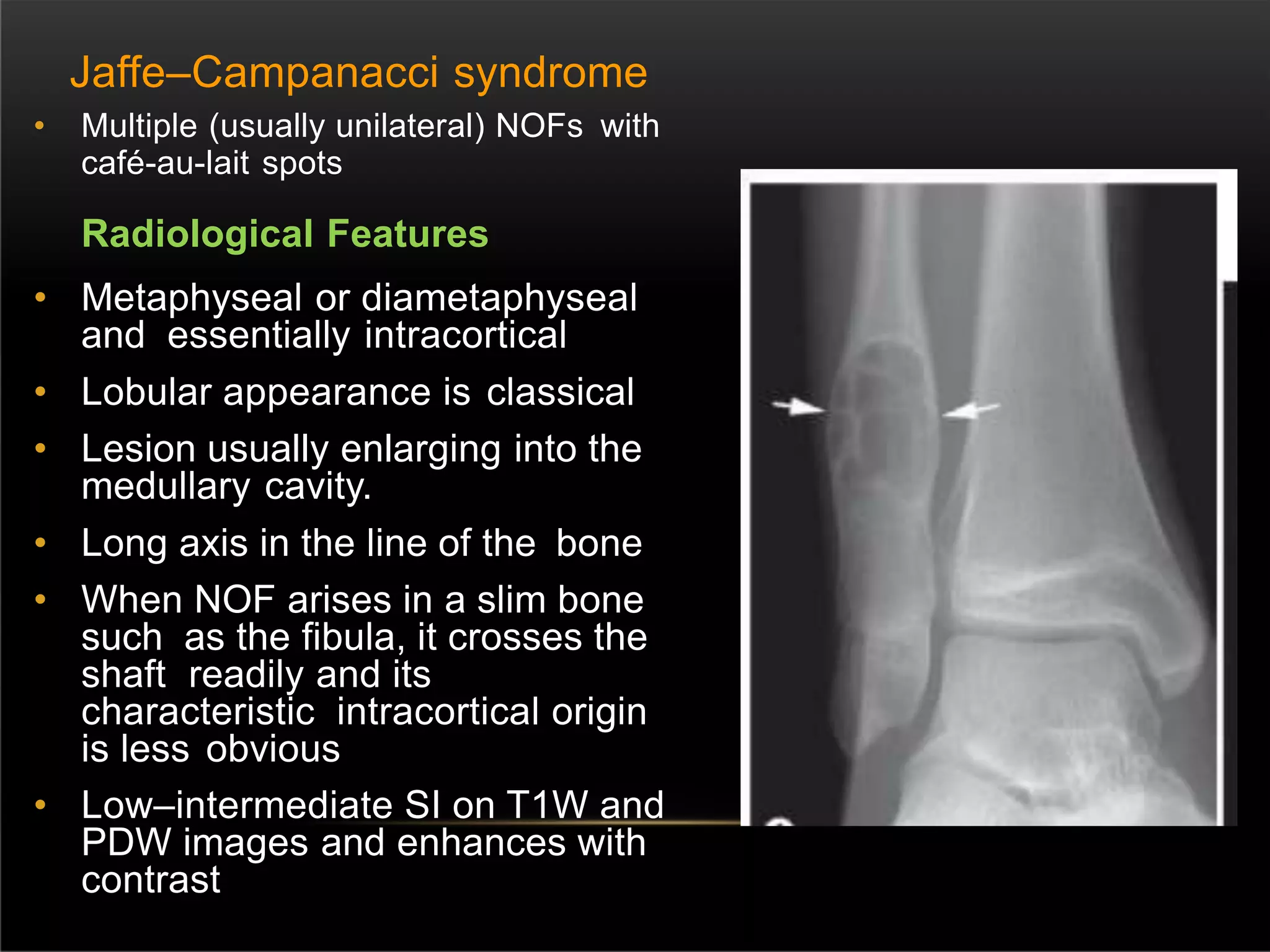 BENIGN Bone tumors