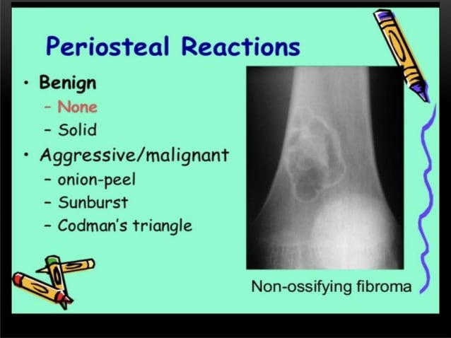 BENIGN Bone tumors | PPT