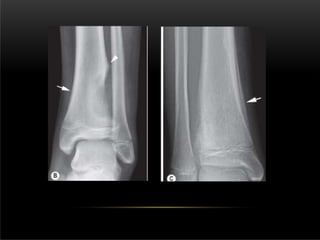 BENIGN Bone tumors | PPT