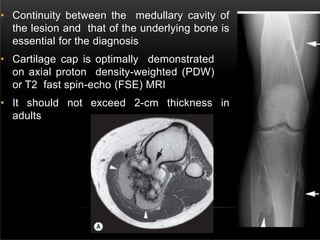 BENIGN Bone tumors | PPT