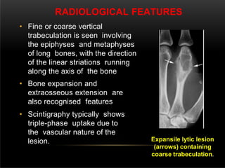 BENIGN Bone tumors | PPT