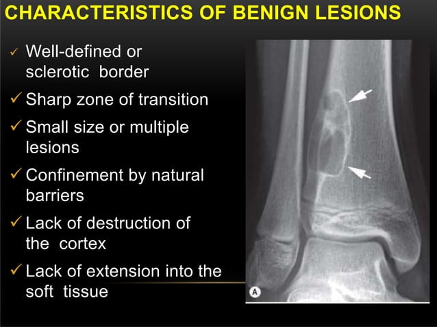BENIGN Bone tumors | PPT