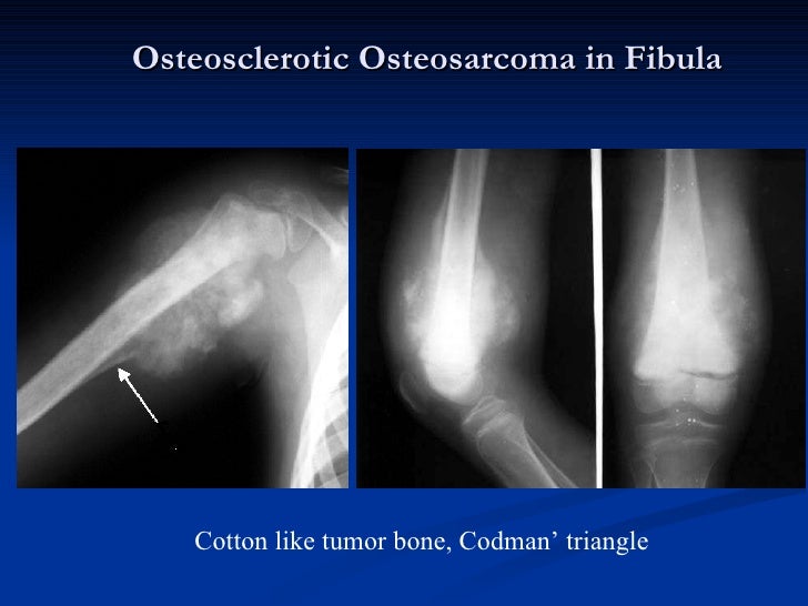 Bone Tumor And Tumor Like Diseases