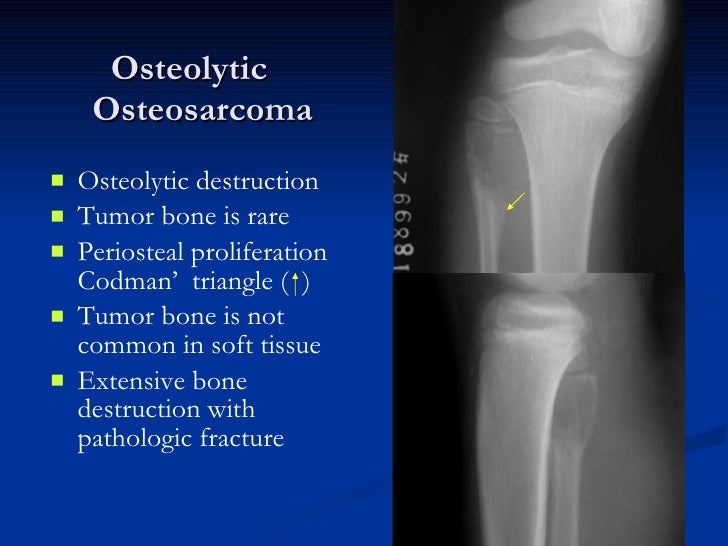Bone Tumor And Tumor Like Diseases
