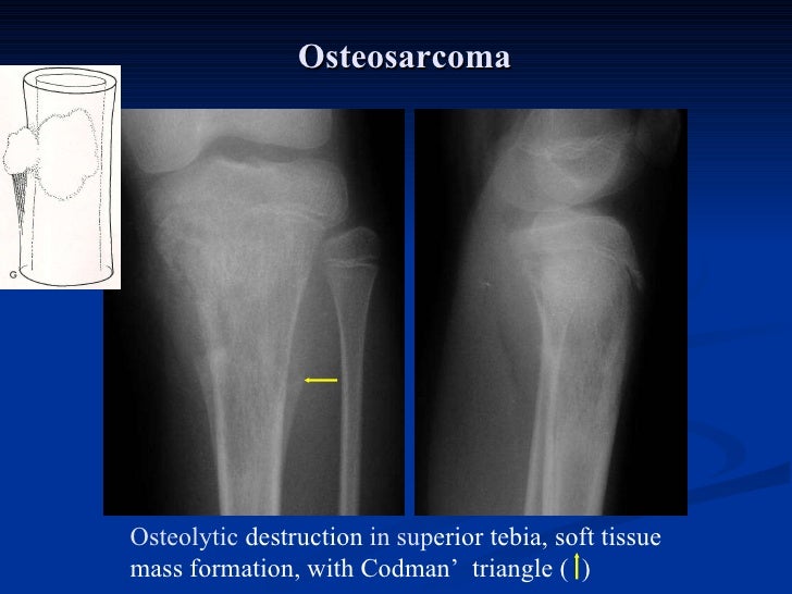 Osteogenic Sarcoma Codmans Triangle