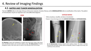 bone tumor ppt.pptx including osteosarcoma | PPTX