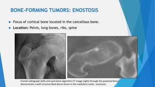 bone tumors-1.pptx