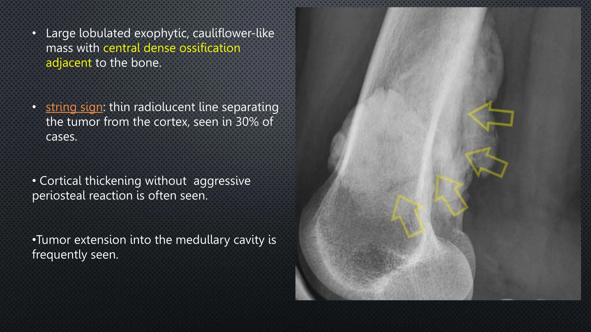 An Approach to BONE TUMORS part one.pptx