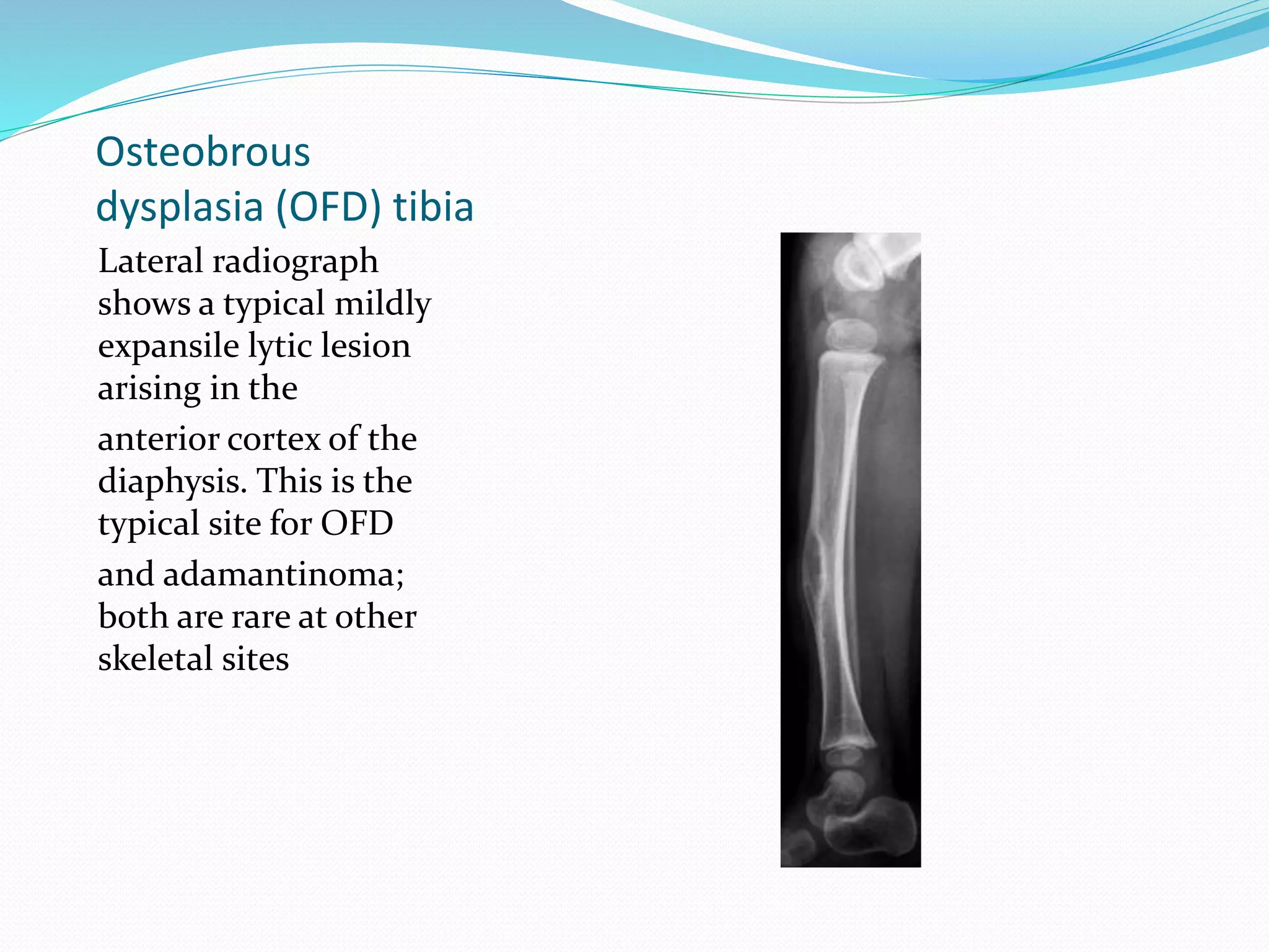 Imaging of Bone Tumors | PPTX