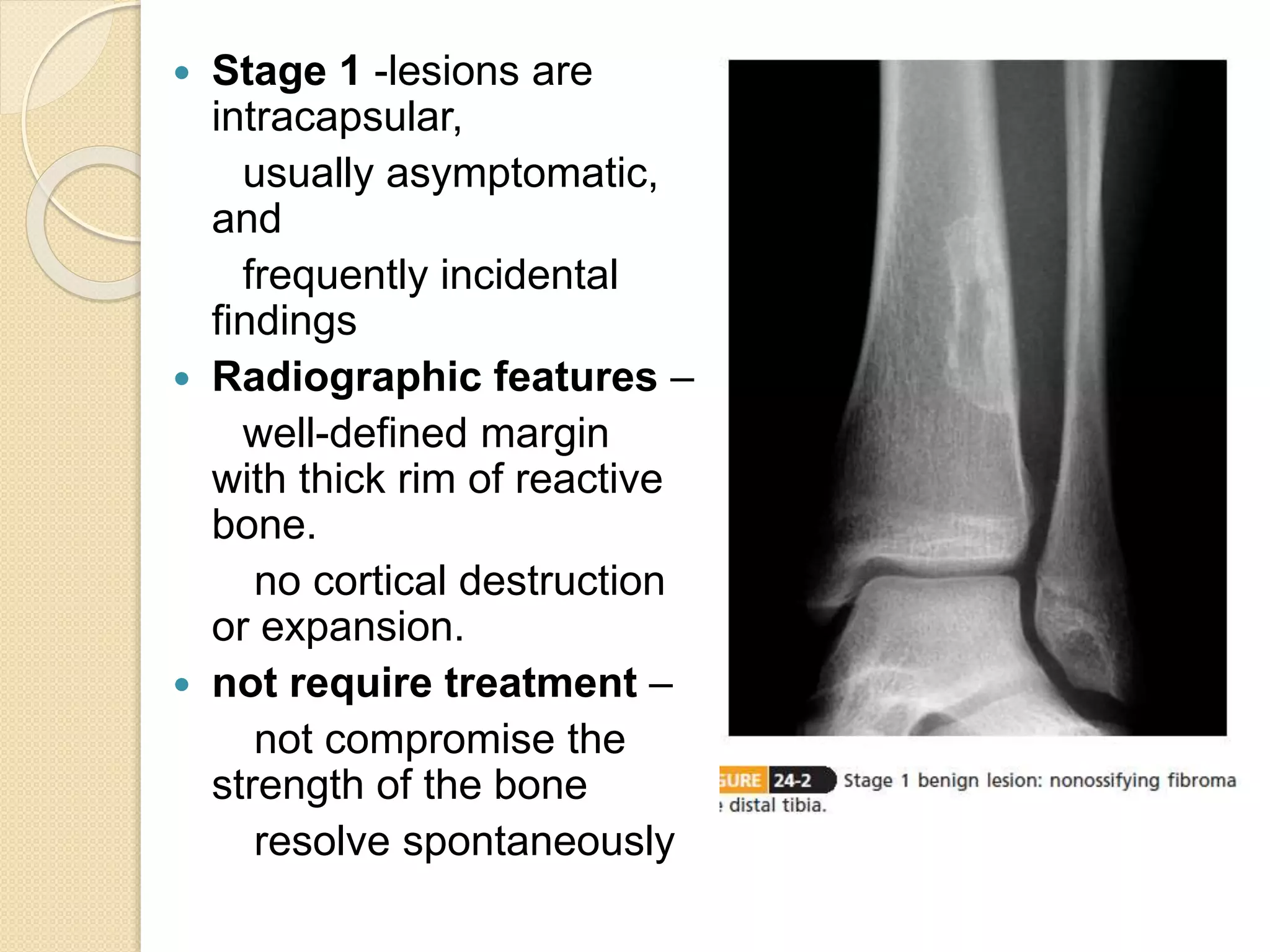 Bone tumors introduction and general principles | PPTX