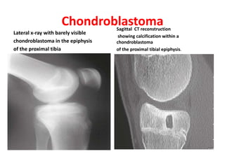 Bone tumors | PPTX