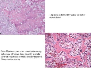 Osteoid Osteoma Histology