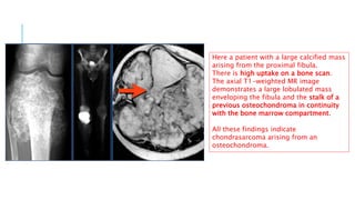 Bone tumors part one | PPTX