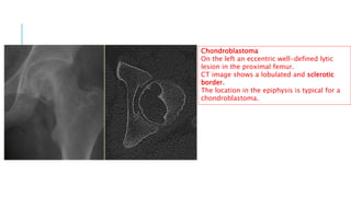 Bone tumors part one | PPTX