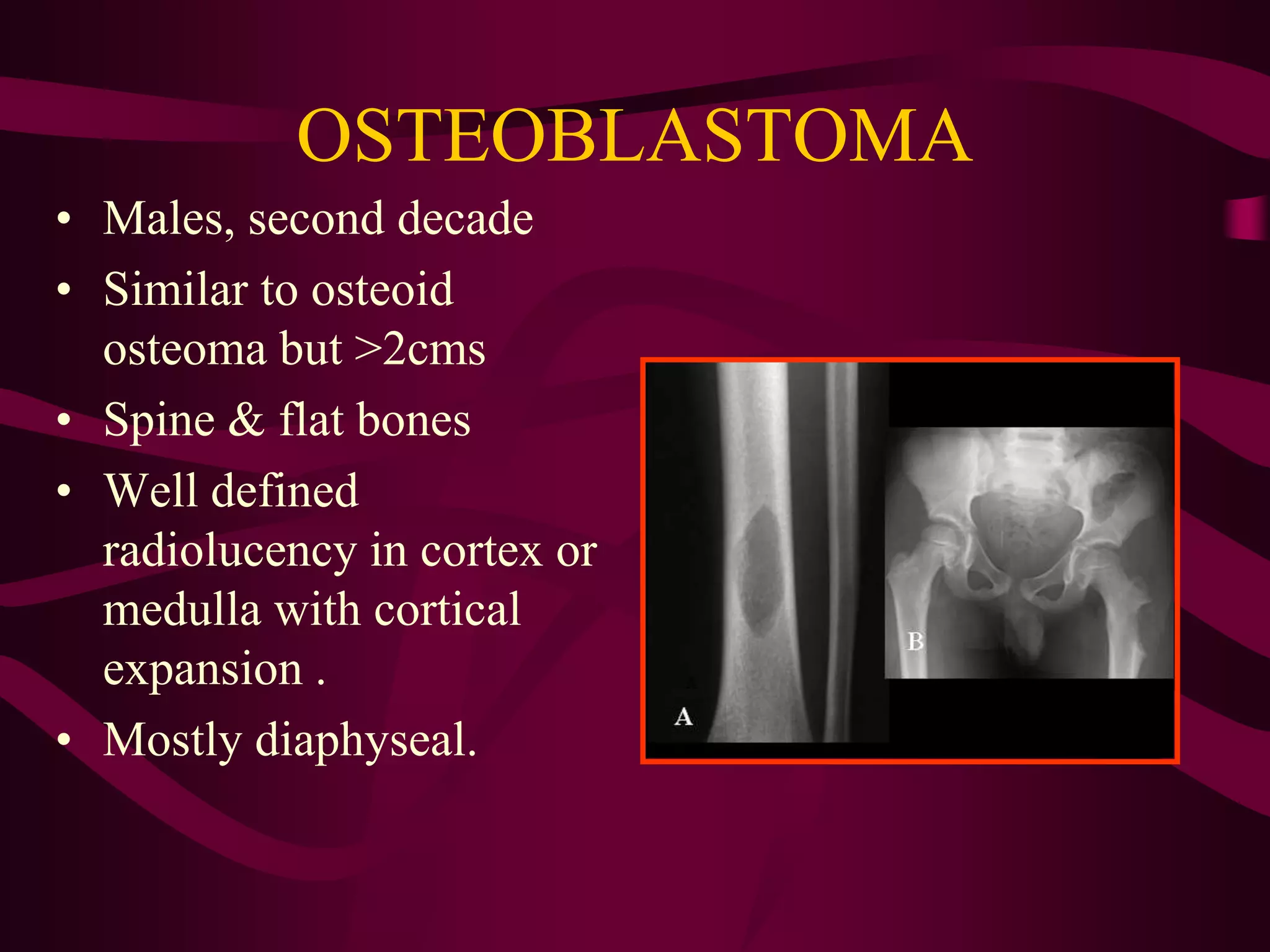 BONE TUMORS.ppt