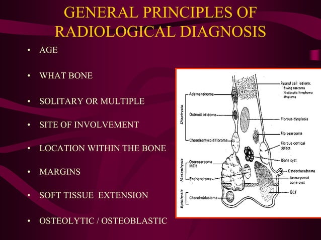 BONE TUMORS.ppt